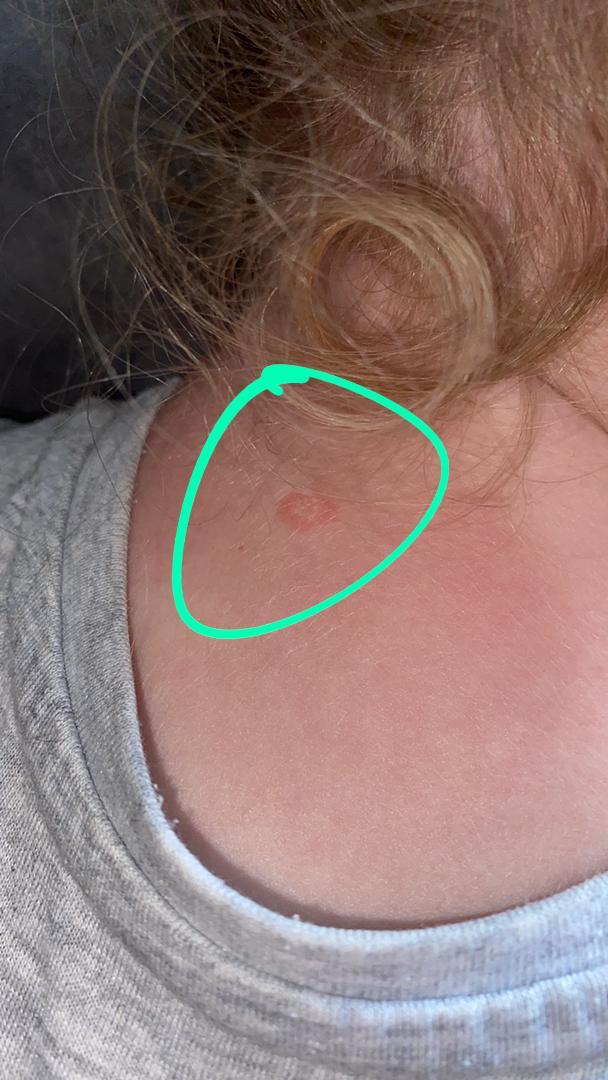 Rash-Ringworm – Healthy Global Kids